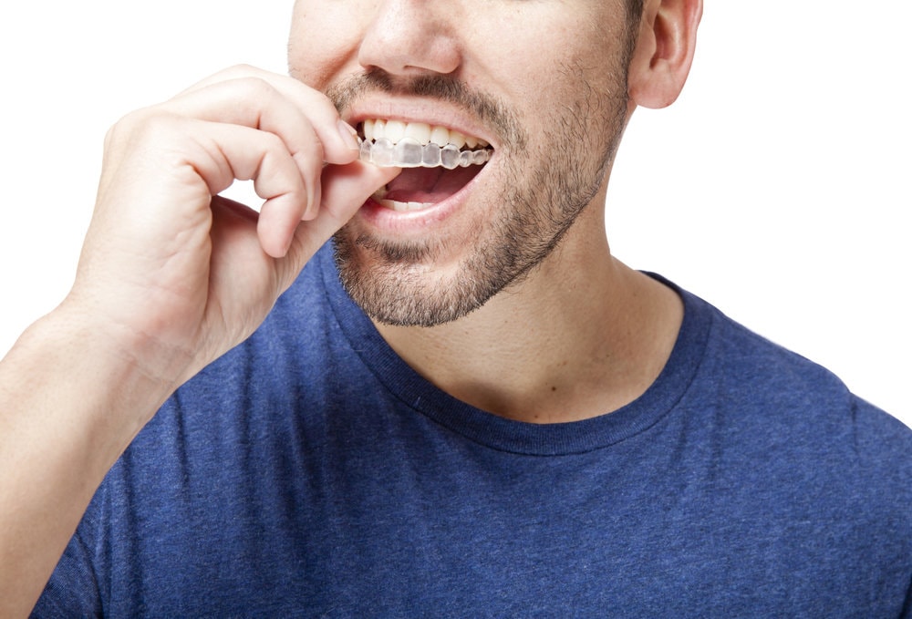 Benefits Of Invisalign Dr Kishor s Dentistry