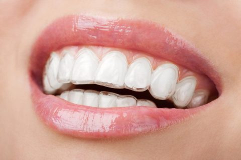 Pros and cons of Invisalign