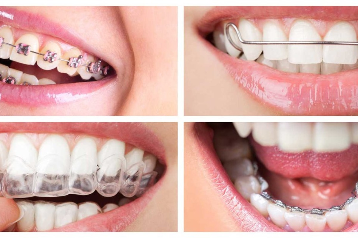 What Are The 2 Types Of Braces Infoupdate What Are The 2 Types Of Braces Infoupdate