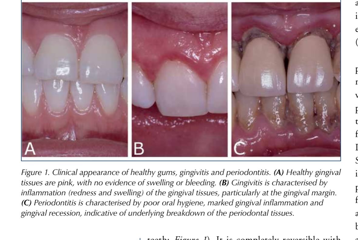 Diabetes and Oral Health - Dr. Kishor's Dentistry